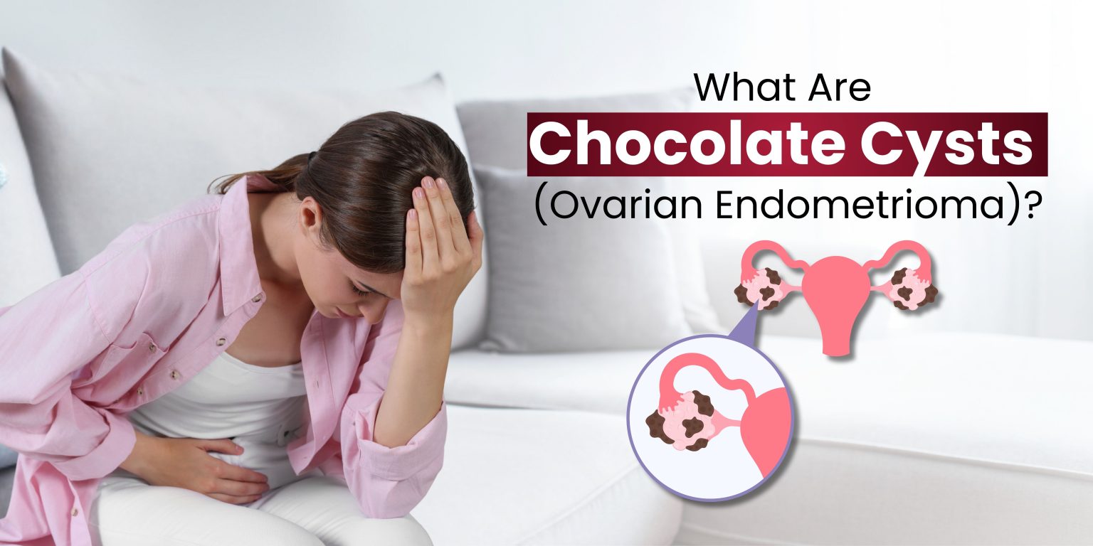 What Are Chocolate Cysts (Ovarian Endometrioma)?